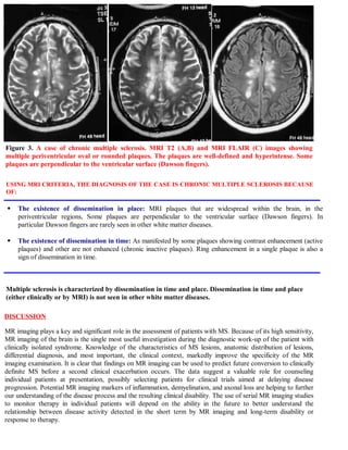 Short case...Multiple sclerosis | PDF