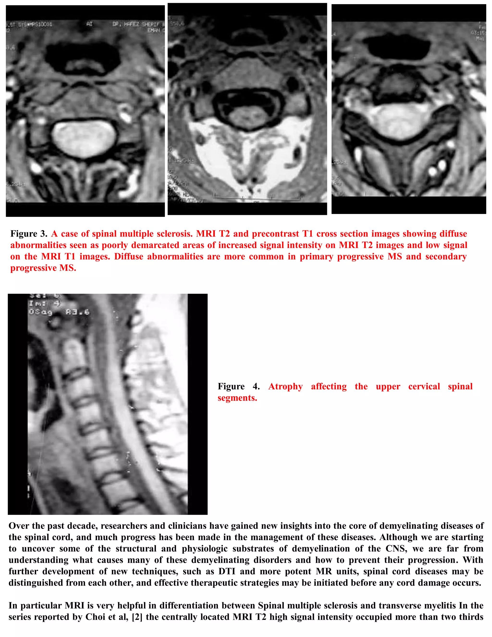 Short case...Spinal multiple sclerosis | PDF