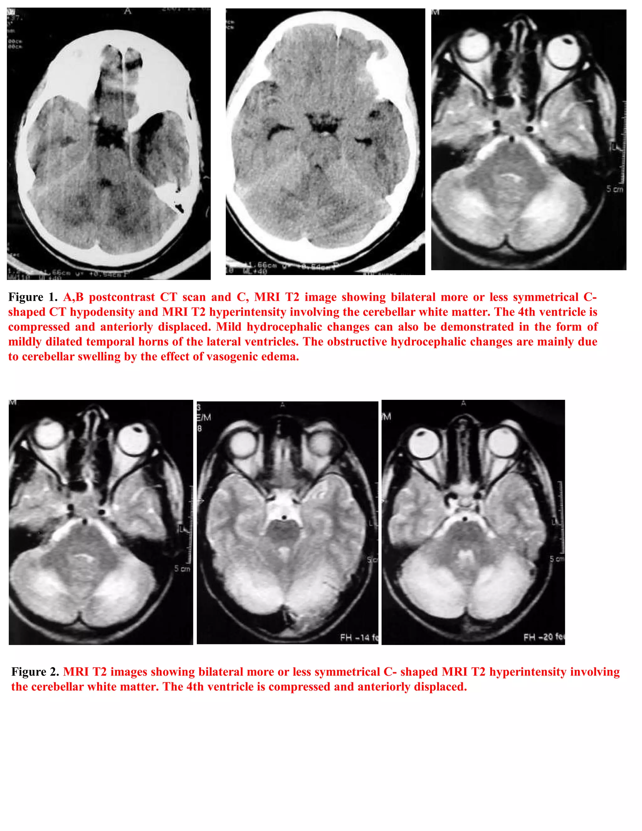Short case...Postinfectious cerebellitis | PDF