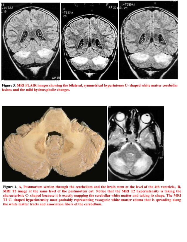 Short case...Postinfectious cerebellitis | PDF