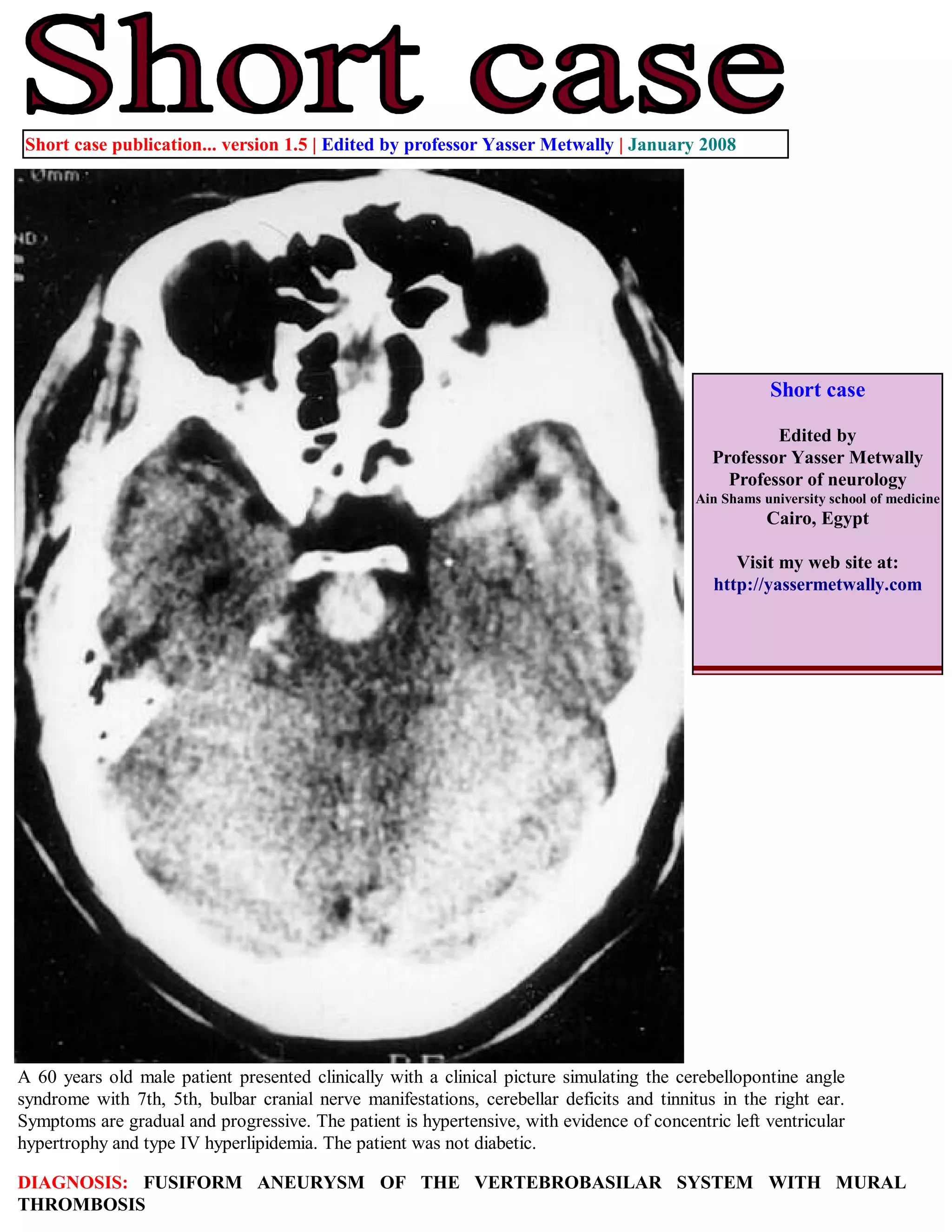 Short case... Arterial ectasia of the vertebrobasilar system | PDF