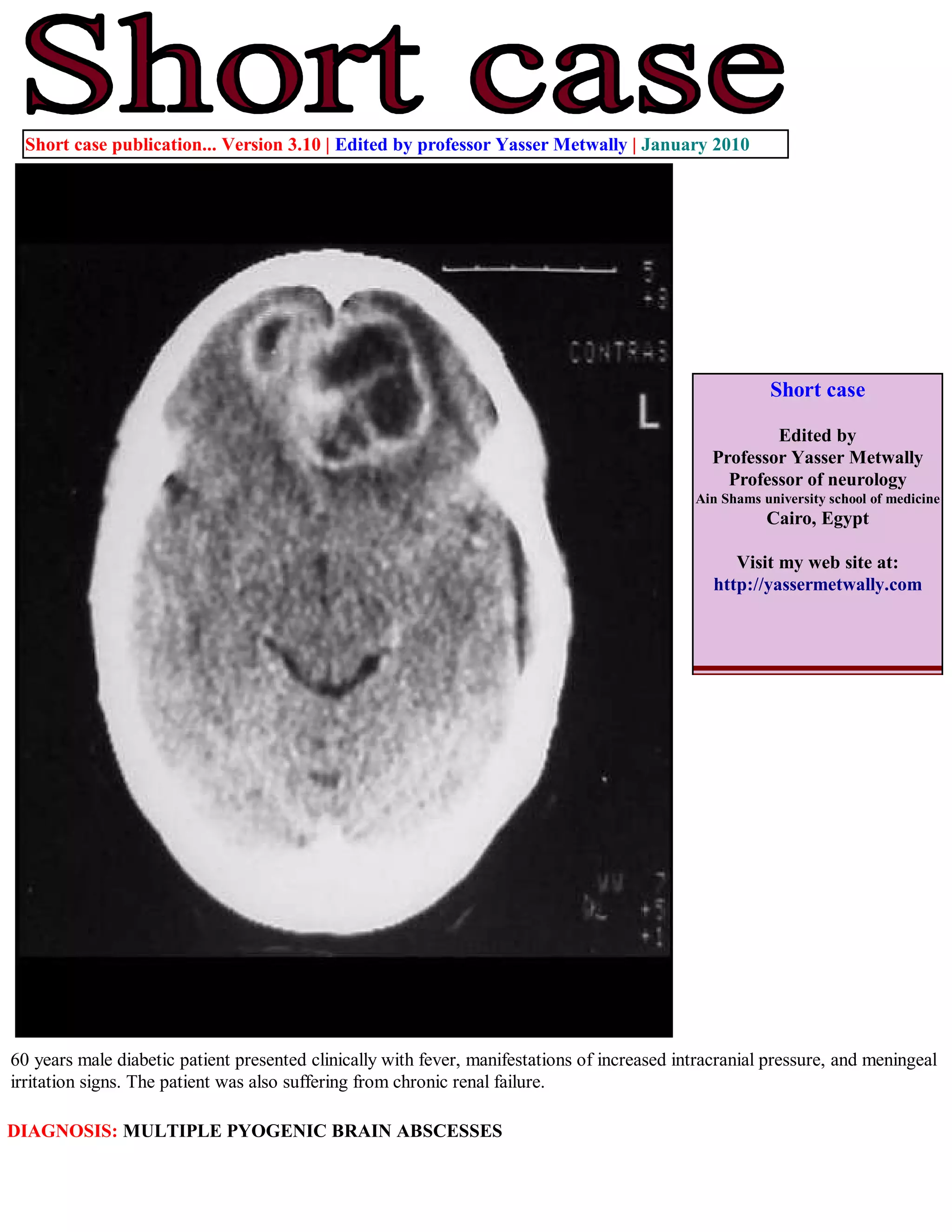 Short case...Multiple pyogenic brain abscesses | PDF