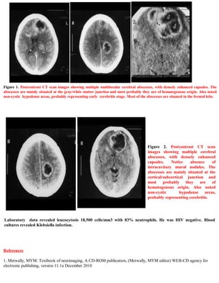 Short case...Multiple pyogenic brain abscesses | PDF