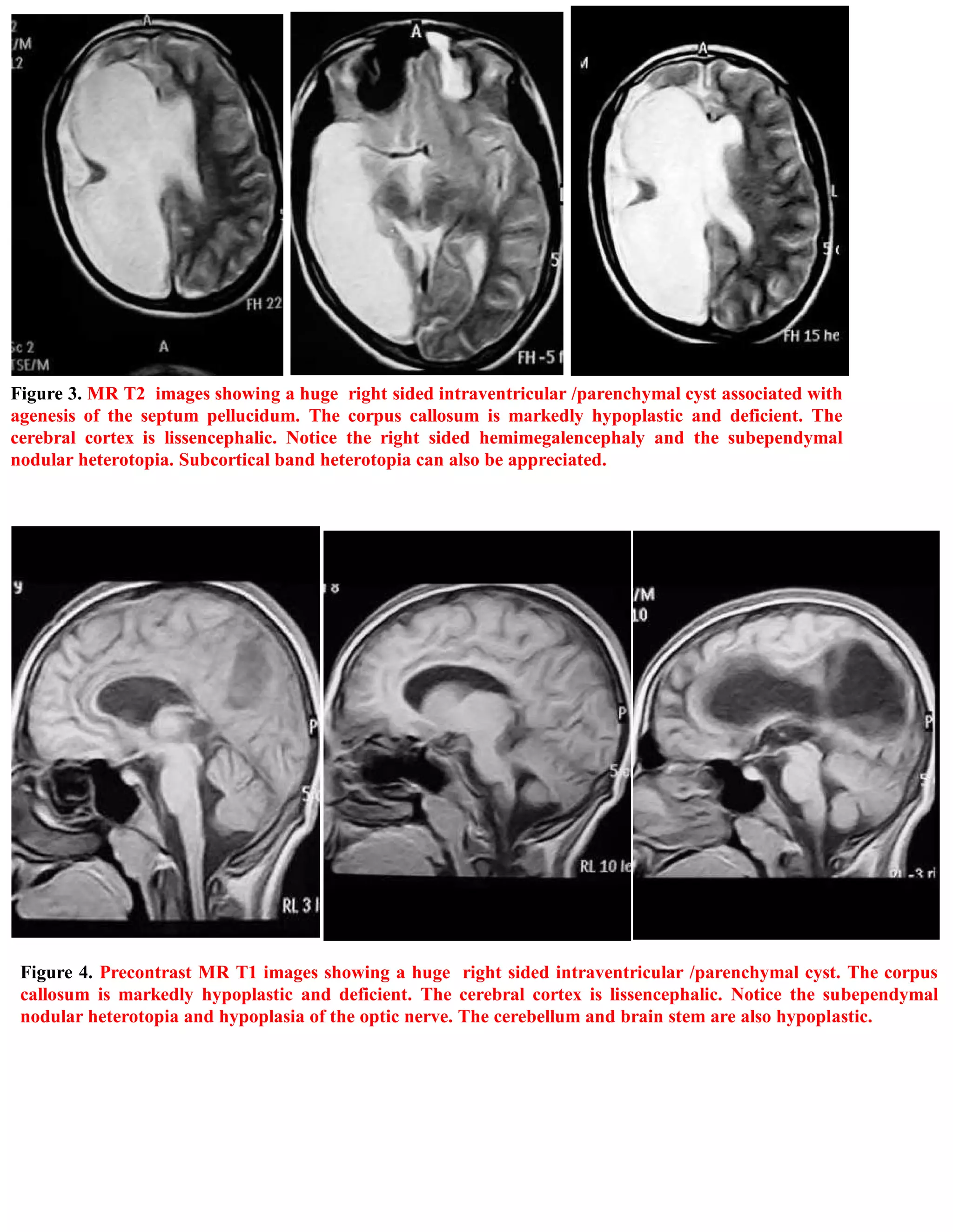 Short case...Aicardi syndrome | PDF