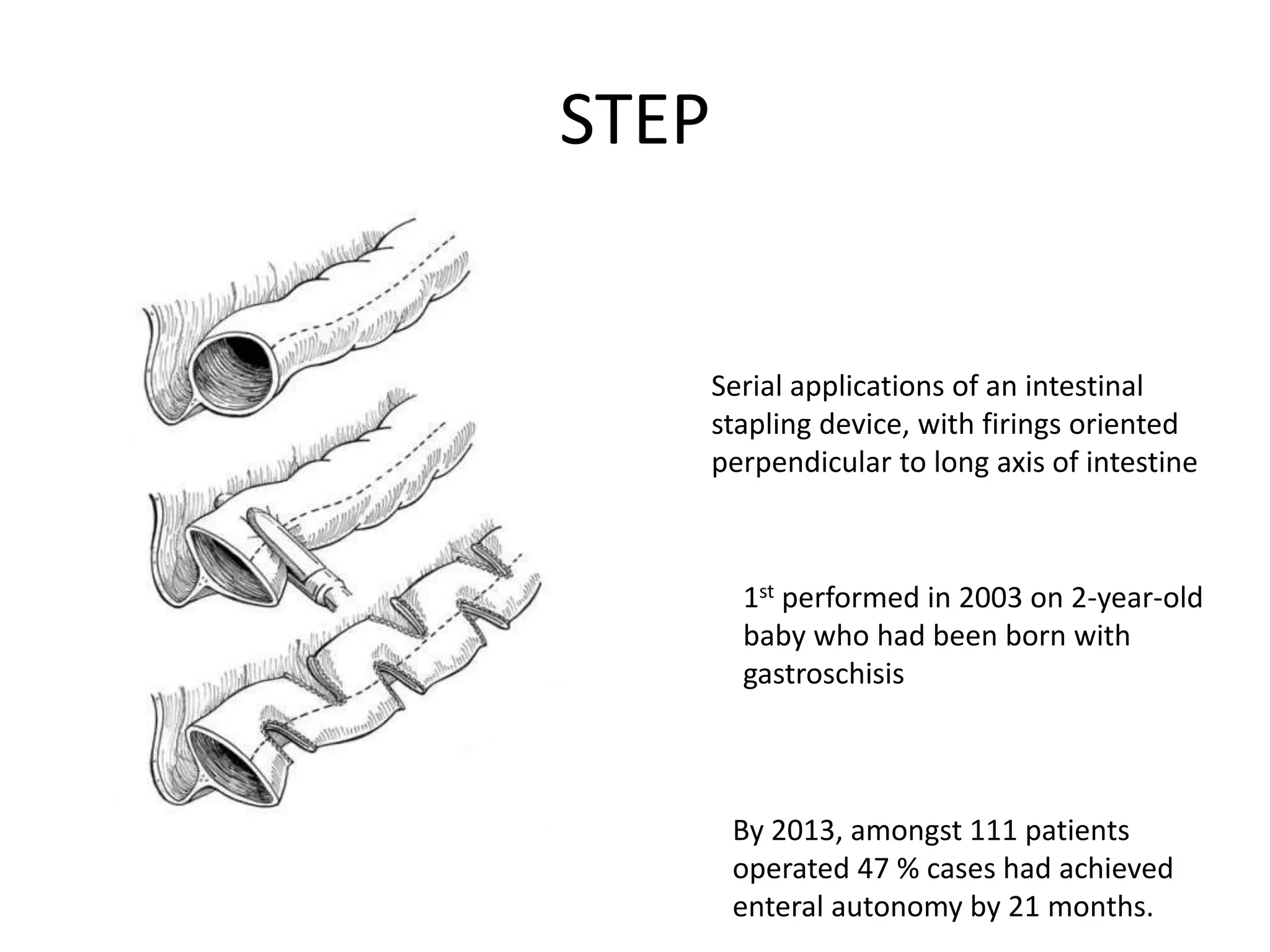 Short bowel syndrome | PPTX