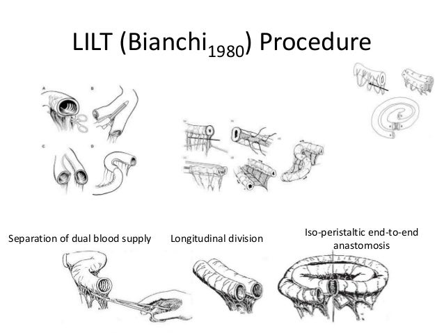 Short bowel syndrome