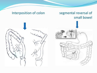 Short bowel syndrome | PPTX