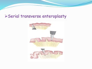 Short bowel syndrome | PPTX
