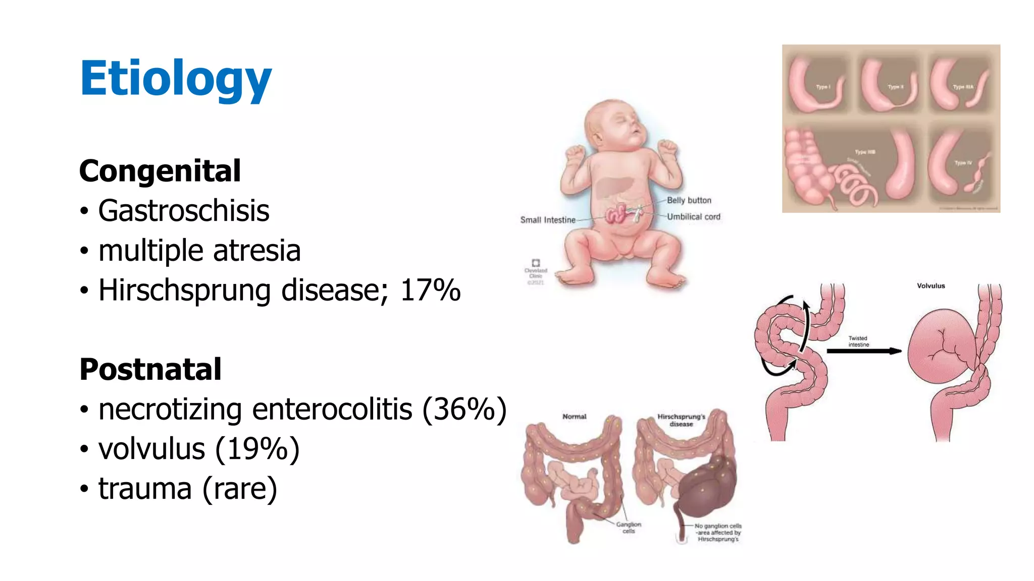 Short Bowel syndrome Dr Habibur Rahim | PPTX