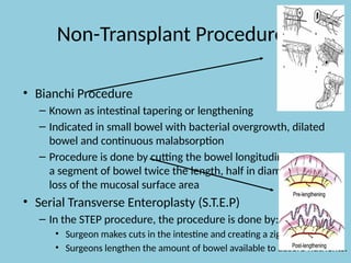 Short Bowel Syndrome | PPT