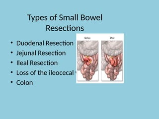 Short Bowel Syndrome | PPT