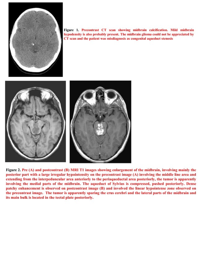 Short case...Focal midbrain glioma | PDF