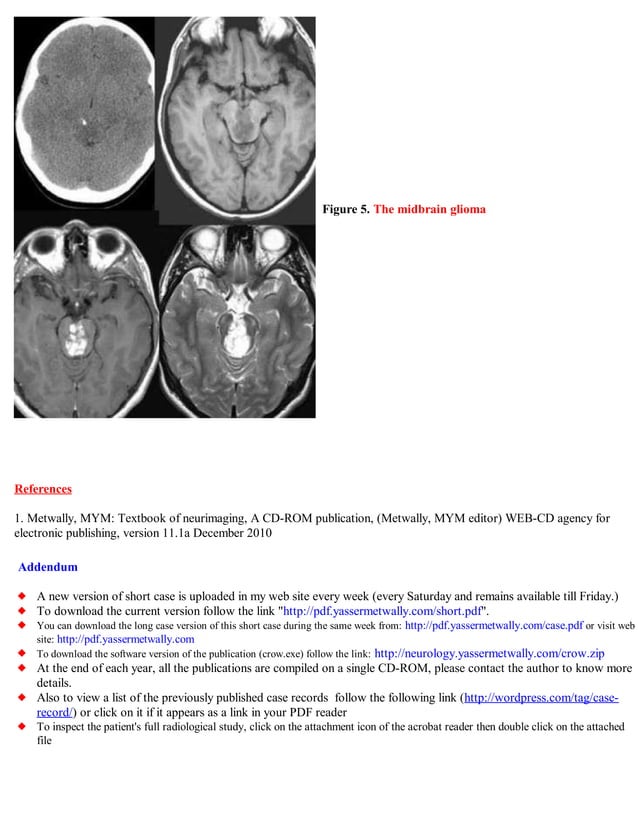 Short case...Focal midbrain glioma | PDF