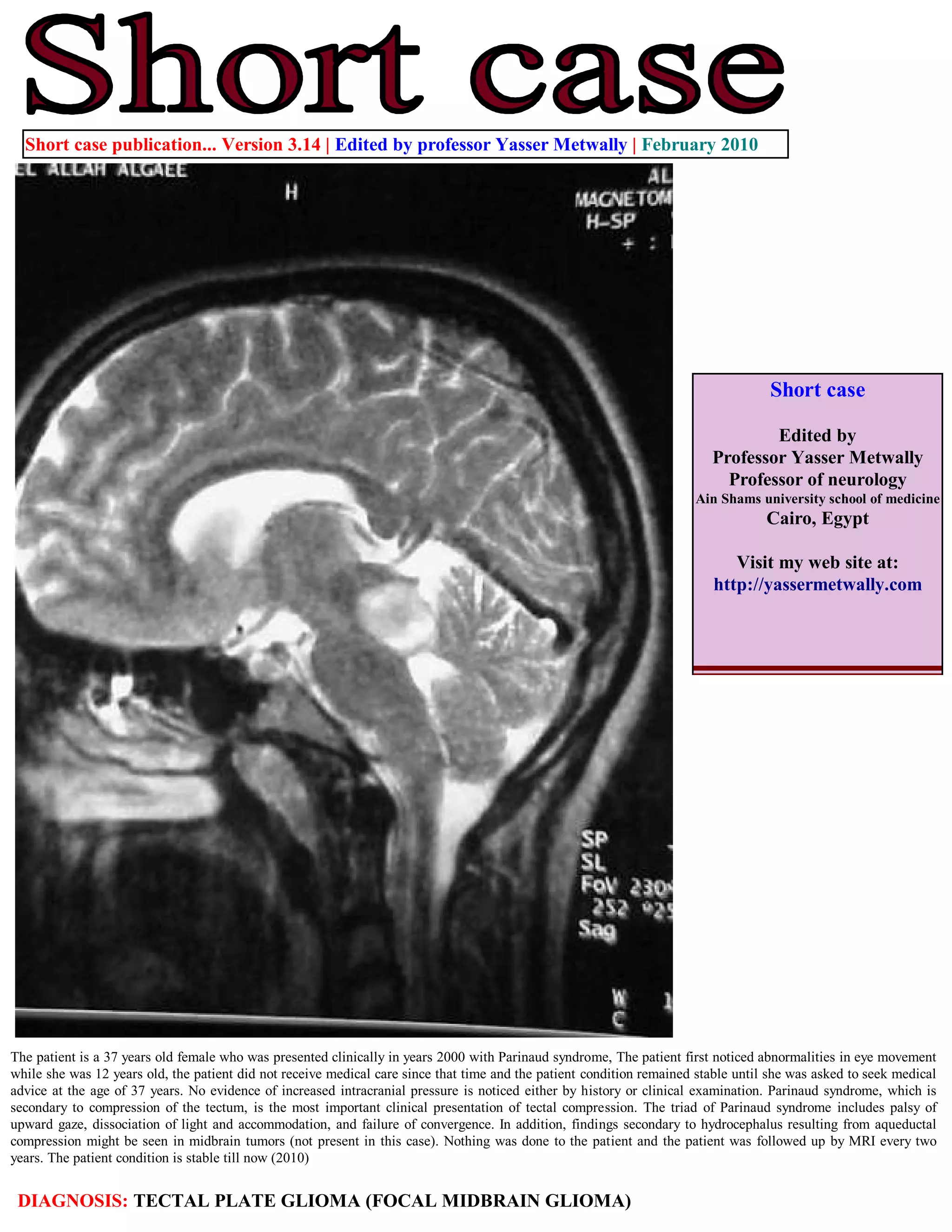 Short case...tectal plate glioma | PDF