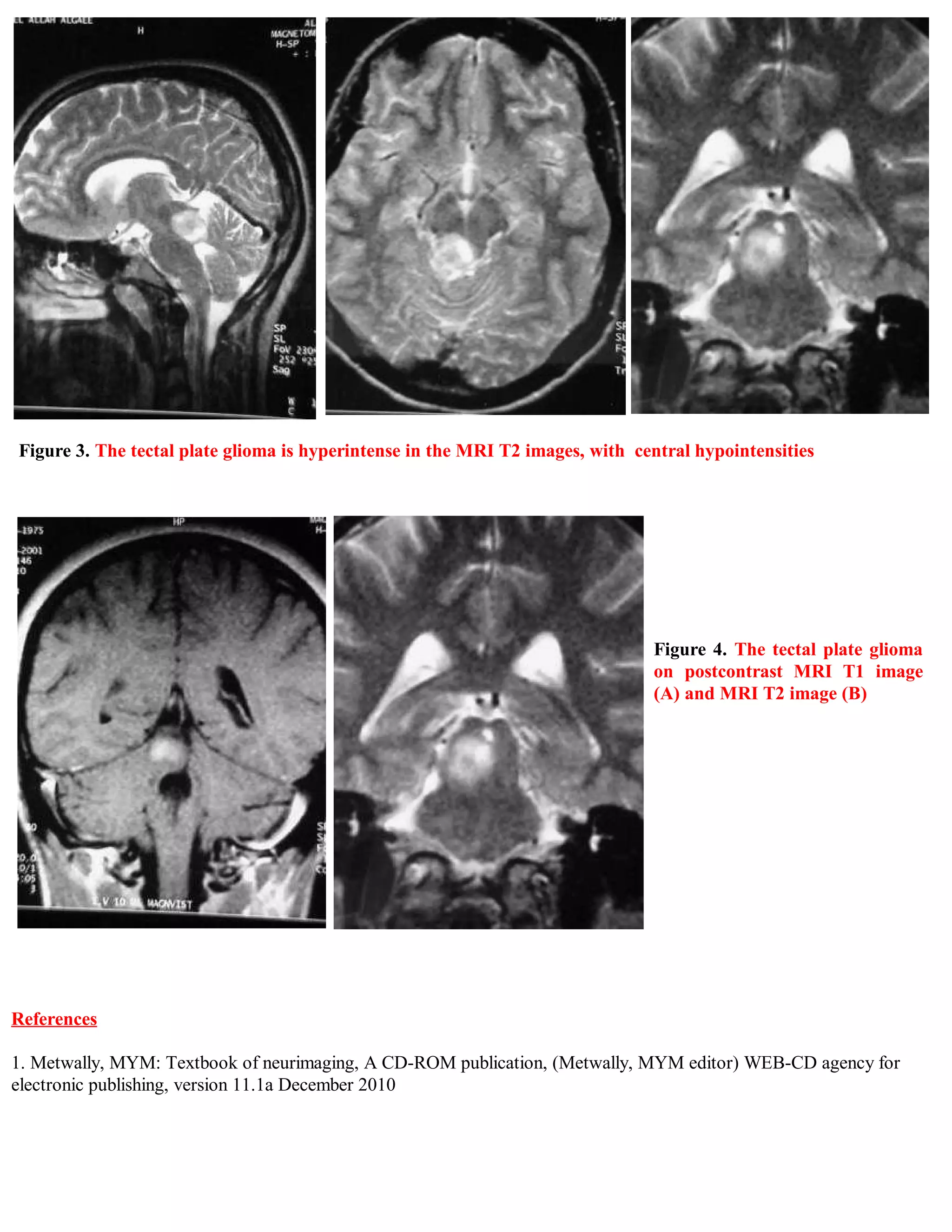 Short case...tectal plate glioma | PDF