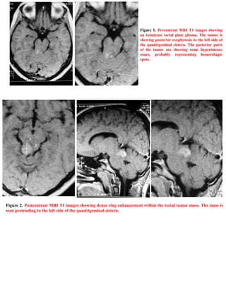 Short case...tectal plate glioma | PDF