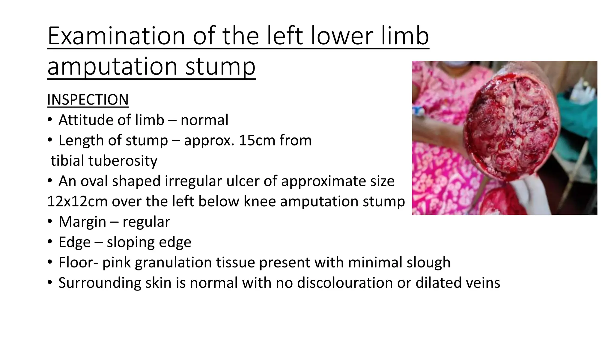 short case of amputation stump, anand copy.pptx