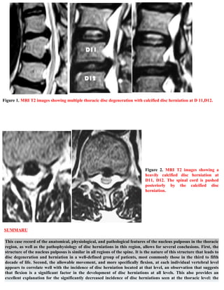 Short case...Heavily calcified dorsal disc herniation at D11,D2 disc ...