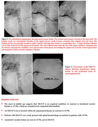 Short case...Spinal dural arteriovenous fistula | PDF