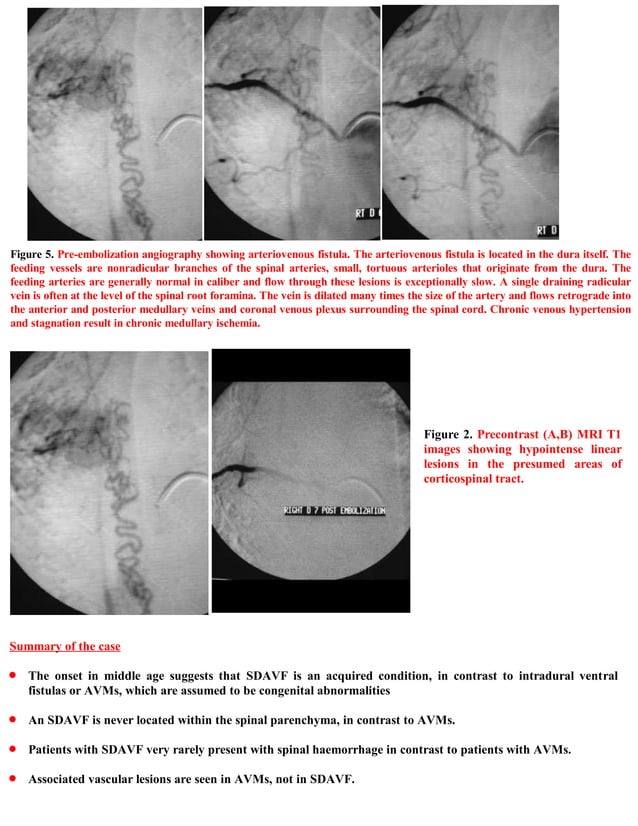 Short Case Spinal Dural Arteriovenous Fistula Pdf