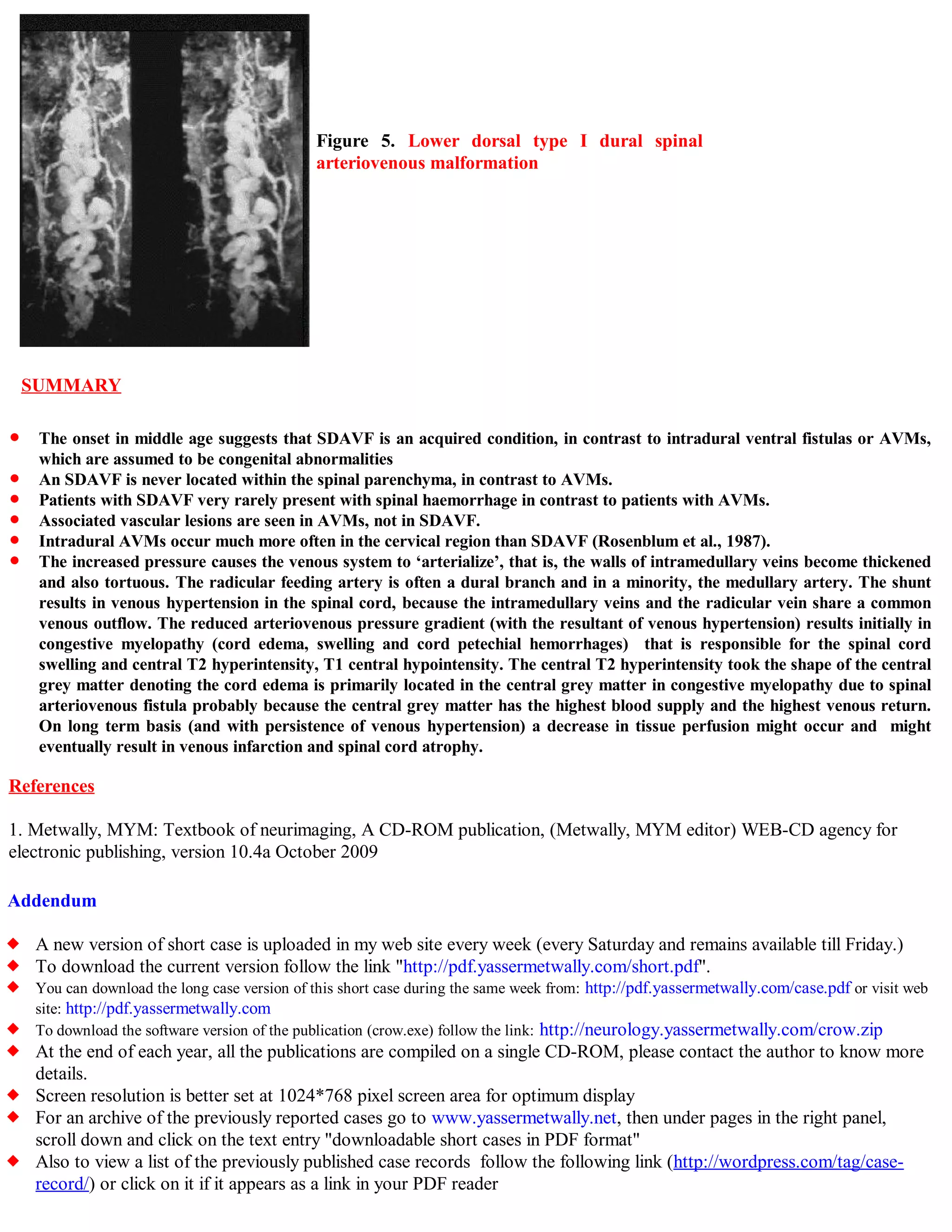 Short case...Spinal dural arteriovenous fistula withn congestive ...