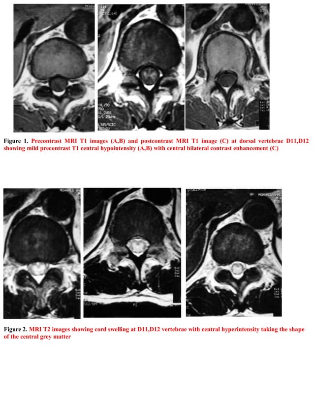 Short case...Spinal dural arteriovenous fistula withn congestive ...
