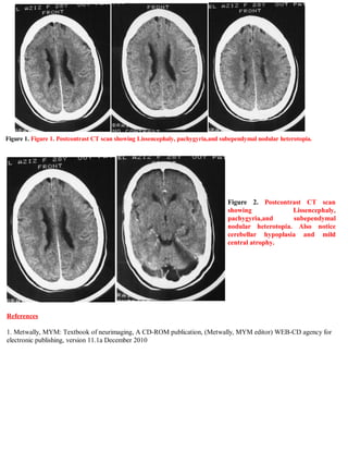 Short case...Cortical dysplasia | PDF