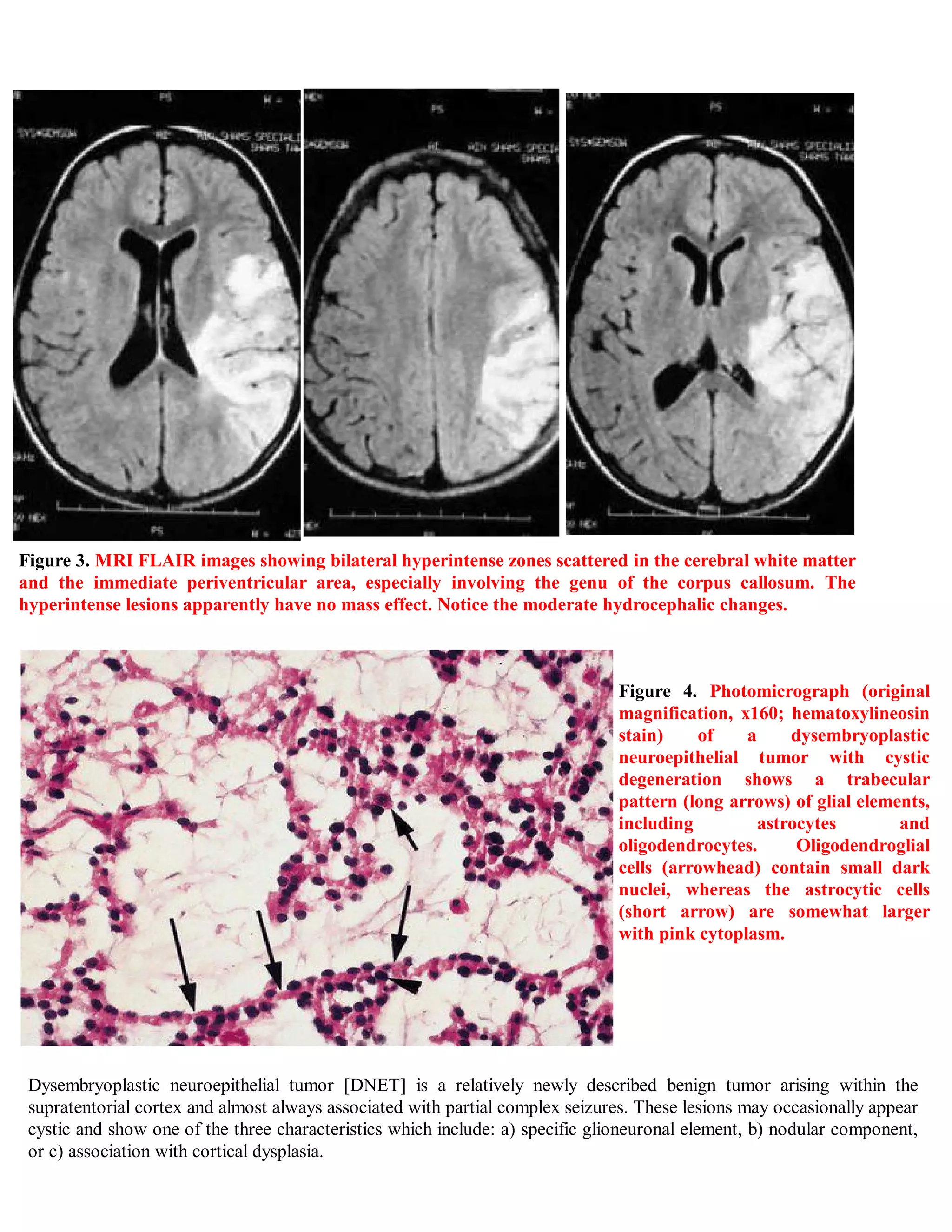 Short case...Dysembryoplastic neuroepithelial tumor | PDF