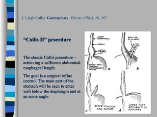 SECONDARY SHORT ESOPHAGUS DUE TO PROLONGED REFLUX | PPT | Free Download