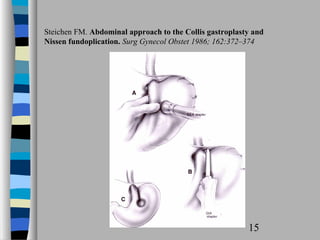 SECONDARY SHORT ESOPHAGUS DUE TO PROLONGED REFLUX | PPT