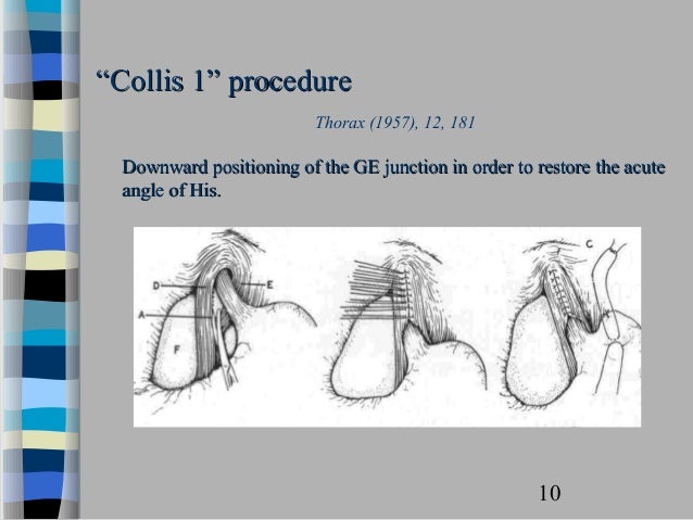 SECONDARY SHORT ESOPHAGUS DUE TO PROLONGED REFLUX