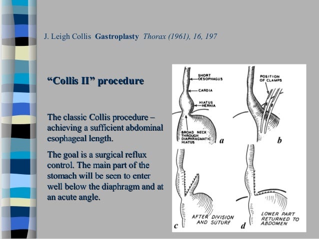 SECONDARY SHORT ESOPHAGUS DUE TO PROLONGED REFLUX