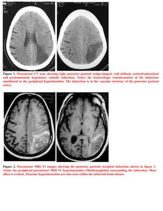 Short case...Arterial embolic hemorrhagic infarction | PDF
