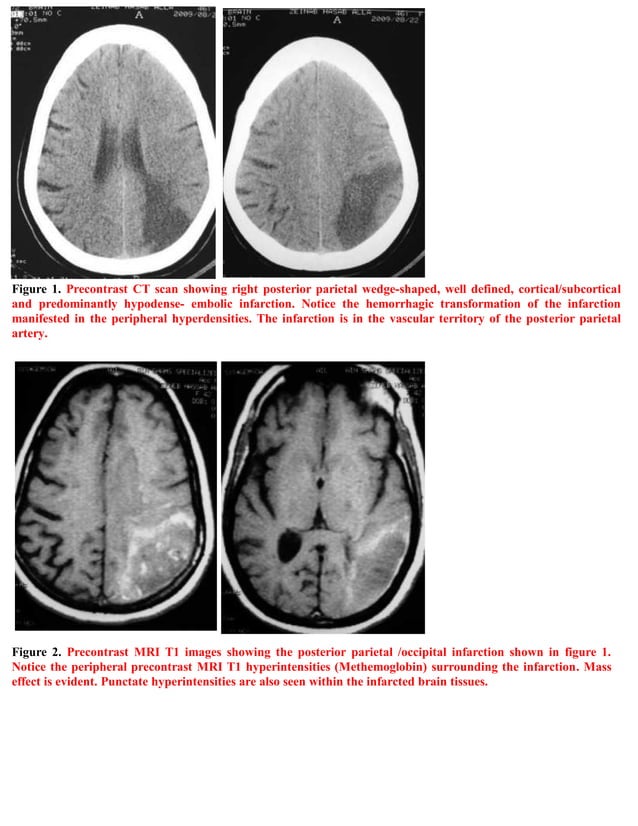 Short case...Arterial embolic hemorrhagic infarction | PDF