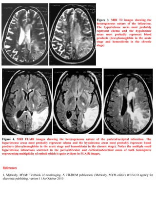 Short case...Arterial embolic hemorrhagic infarction | PDF
