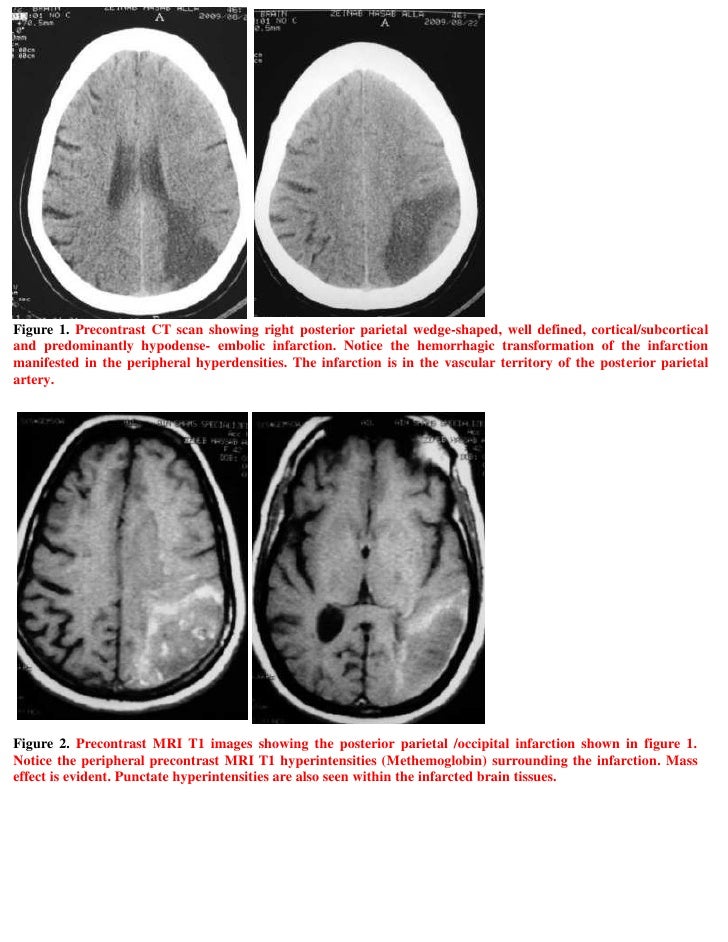 Short case...Arterial embolic hemorrhagic infarction