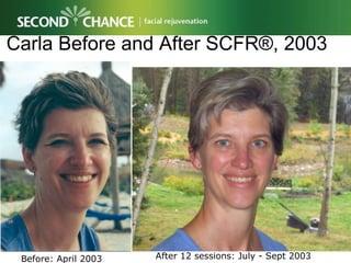 Intro To Second Chance Facial Rejuvenation | PPT