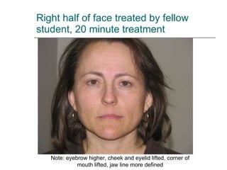 Intro To Second Chance Facial Rejuvenation | PPT