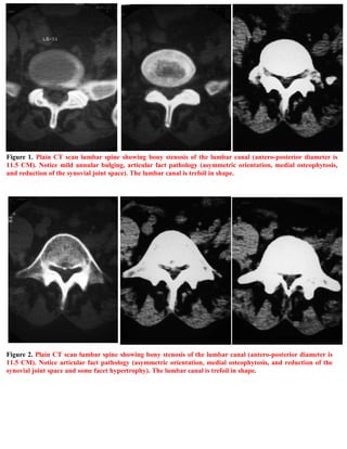 Short case...Lumbar canal stenosis | PDF