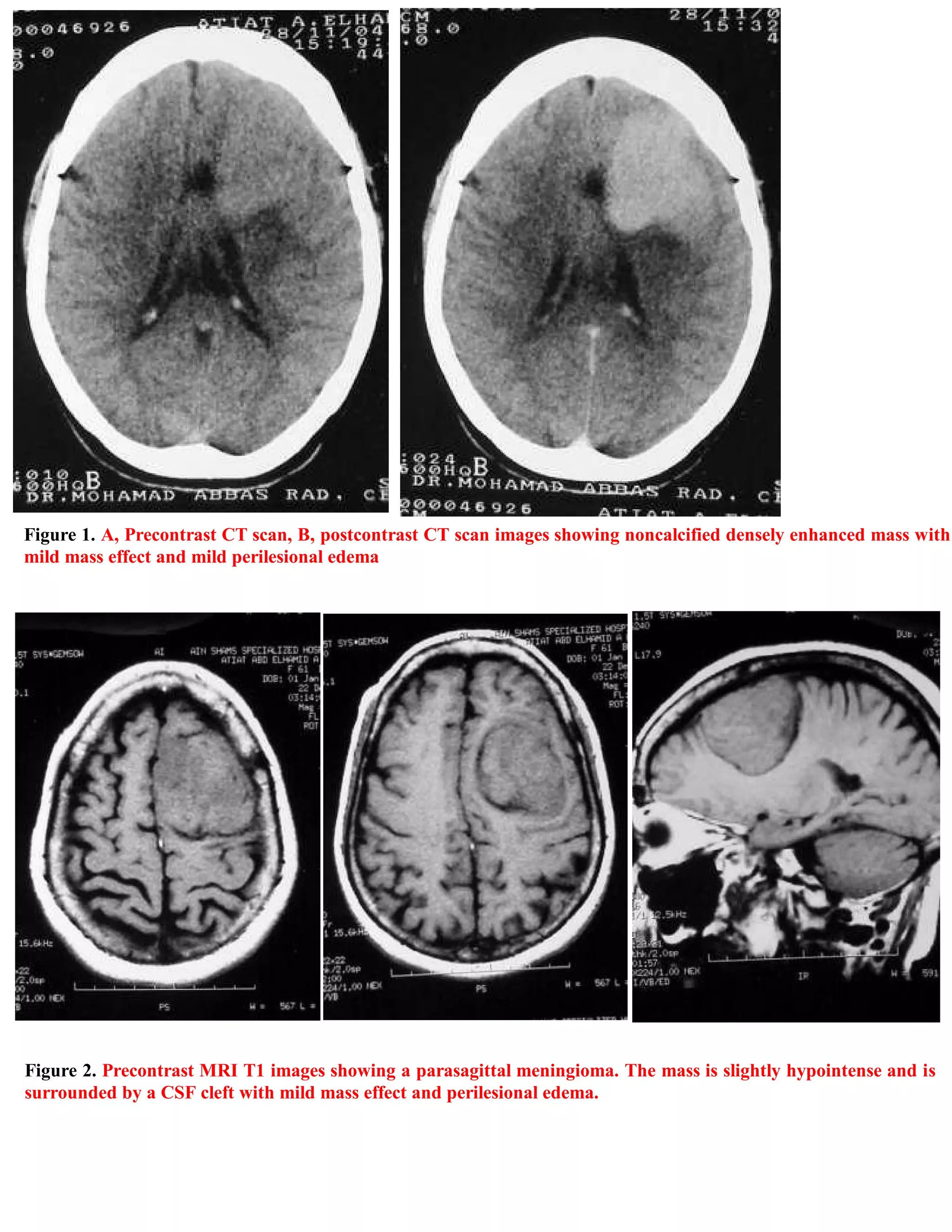 Short case...Parasagittal meningioma | PDF