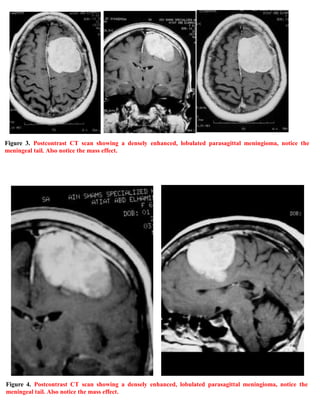 Short case...Parasagittal meningioma | PDF