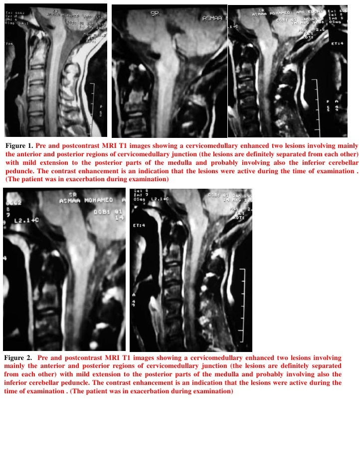 Short Case Multiple Sclerosis Presented Clinically With Bilateral T…