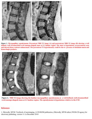Short case...Myxopapillary ependymoma | PDF