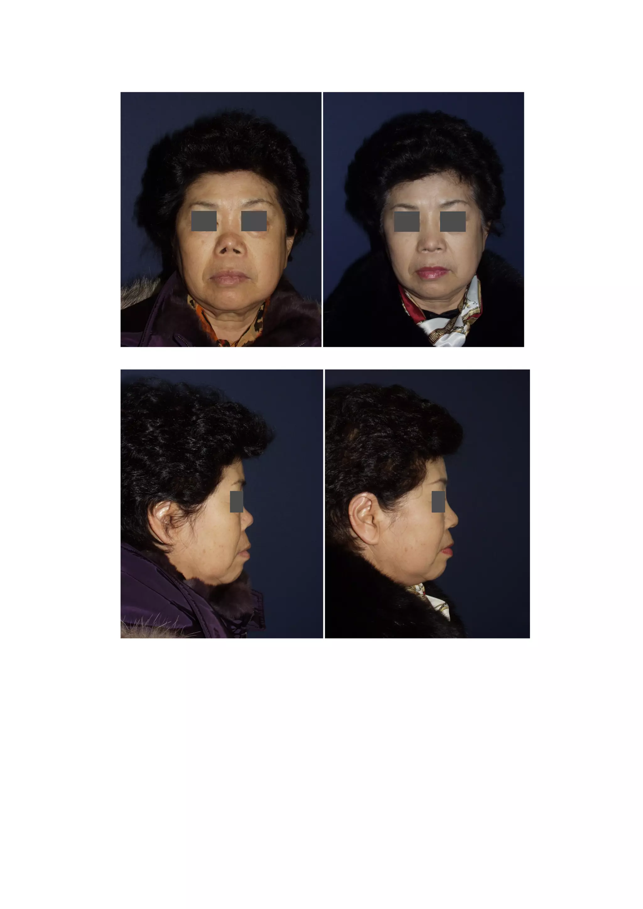 Short nose correction by man koon suh | PDF