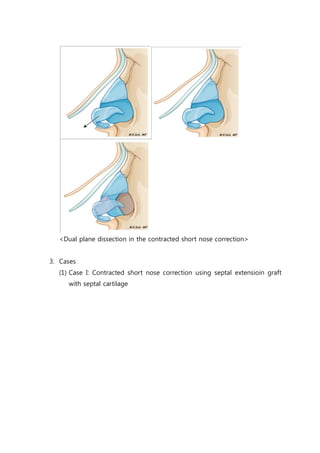 Short nose correction by man koon suh | PDF
