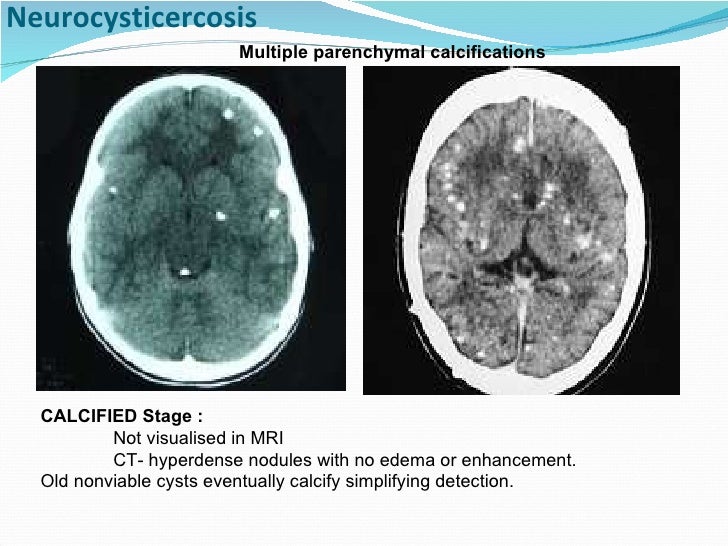 Short presentation version cns infections Lecture