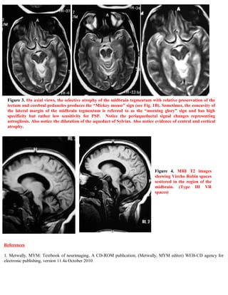 Short case...Progressive supranuclear palsy | PDF | Brain and Nervous ...