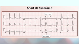 Short QT syndrome. Description, Evaluation, ECG changes. | PDF