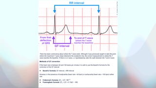 Short QT syndrome. Description, Evaluation, ECG changes. | PDF
