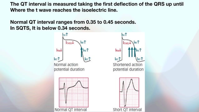 Short QT syndrome. Description, Evaluation, ECG changes. | PPT
